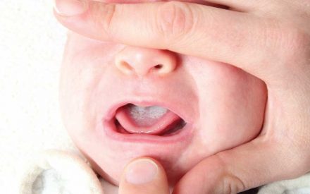 Dealing With Oral Thrush In Babies - BabyTalk - Baby & Kids, Pregnancy ...